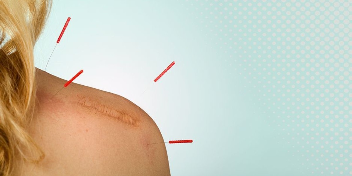 Acupuncture for Scar Healing | Acupuncture Today